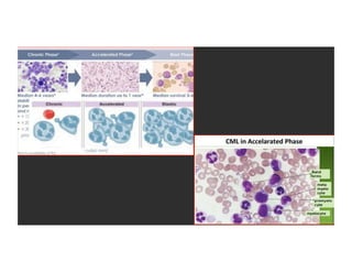 CML.PPT,CHRONIC MYELOID LEUKEMIA:HEMATOLOGY | PDF