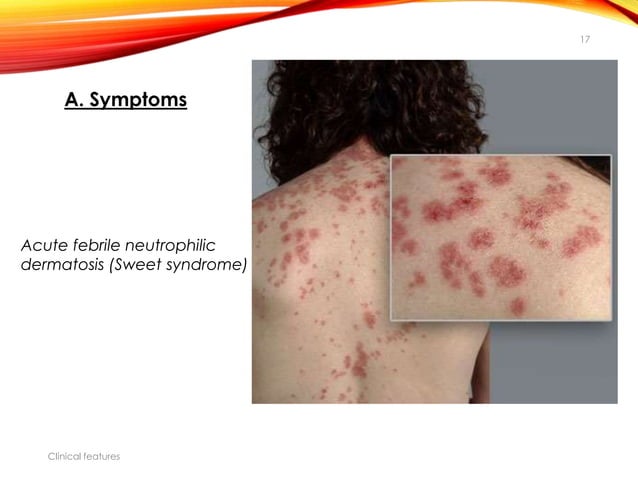 Chronic Myeloid Leukemia