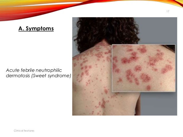 Chronic Myeloid Leukemia