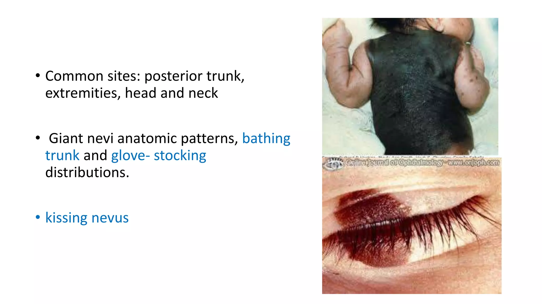 Congenital Melanocytic Nevi + Tissue Expander | PPTX