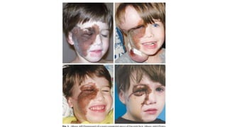 Congenital Melanocytic Nevi + Tissue Expander | PPTX