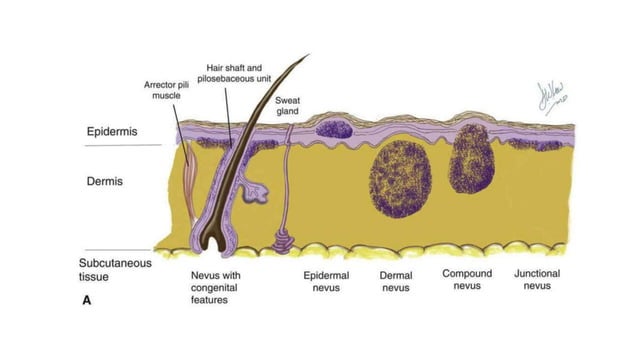 Congenital Melanocytic Nevi + Tissue Expander | PPTX