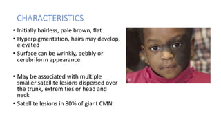 Congenital Melanocytic Nevi + Tissue Expander | PPTX