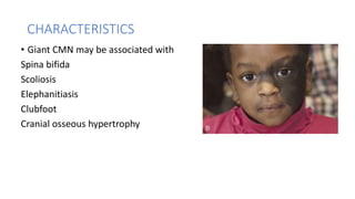 Congenital Melanocytic Nevi + Tissue Expander | PPTX