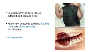 Congenital Melanocytic Nevi + Tissue Expander | PPTX