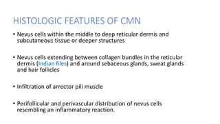 Congenital Melanocytic Nevi + Tissue Expander | PPTX