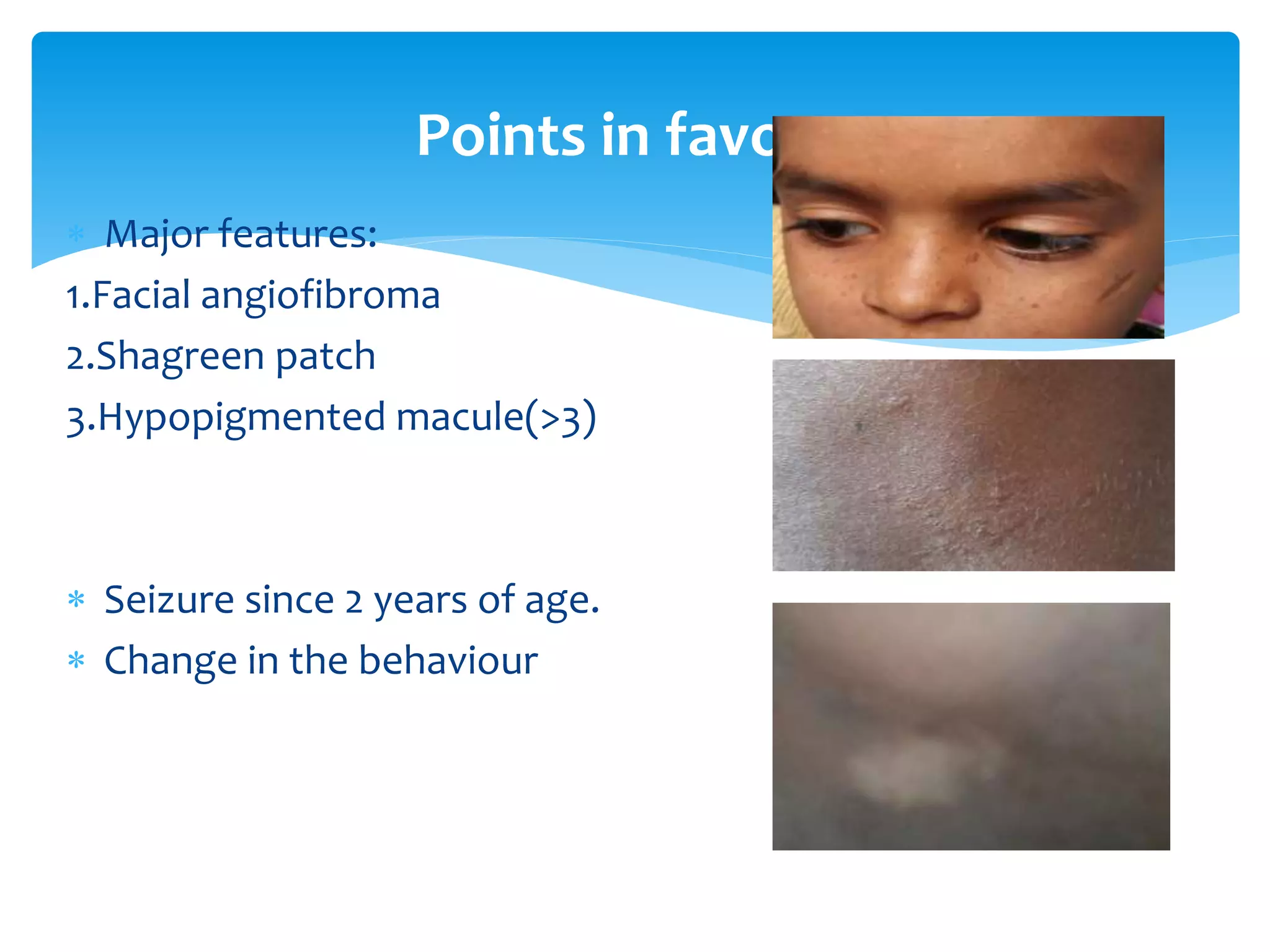 Tuberous Sclerosis | PPTX