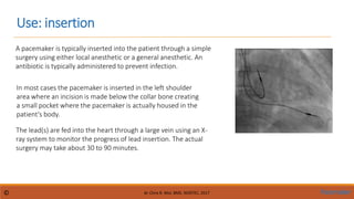 CM Pacemaker pp.pptx