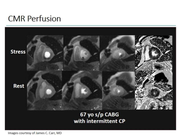 CMR (basic and application) | PPTX | Heart and Cardiovascular Diseases ...