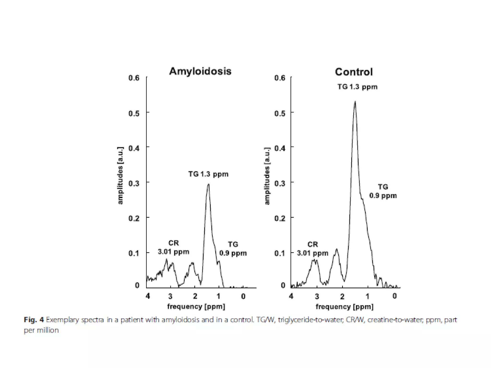 Myocardial triglyceride Cardiac Amyloidosis MR Spectroscopy | PPTX ...