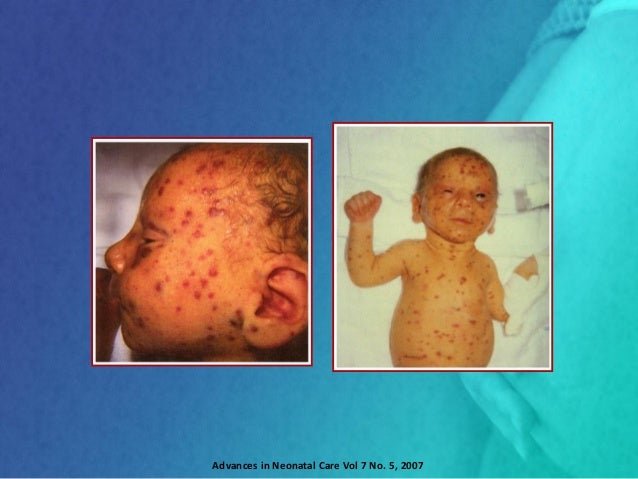 Citomegalovirus congénito