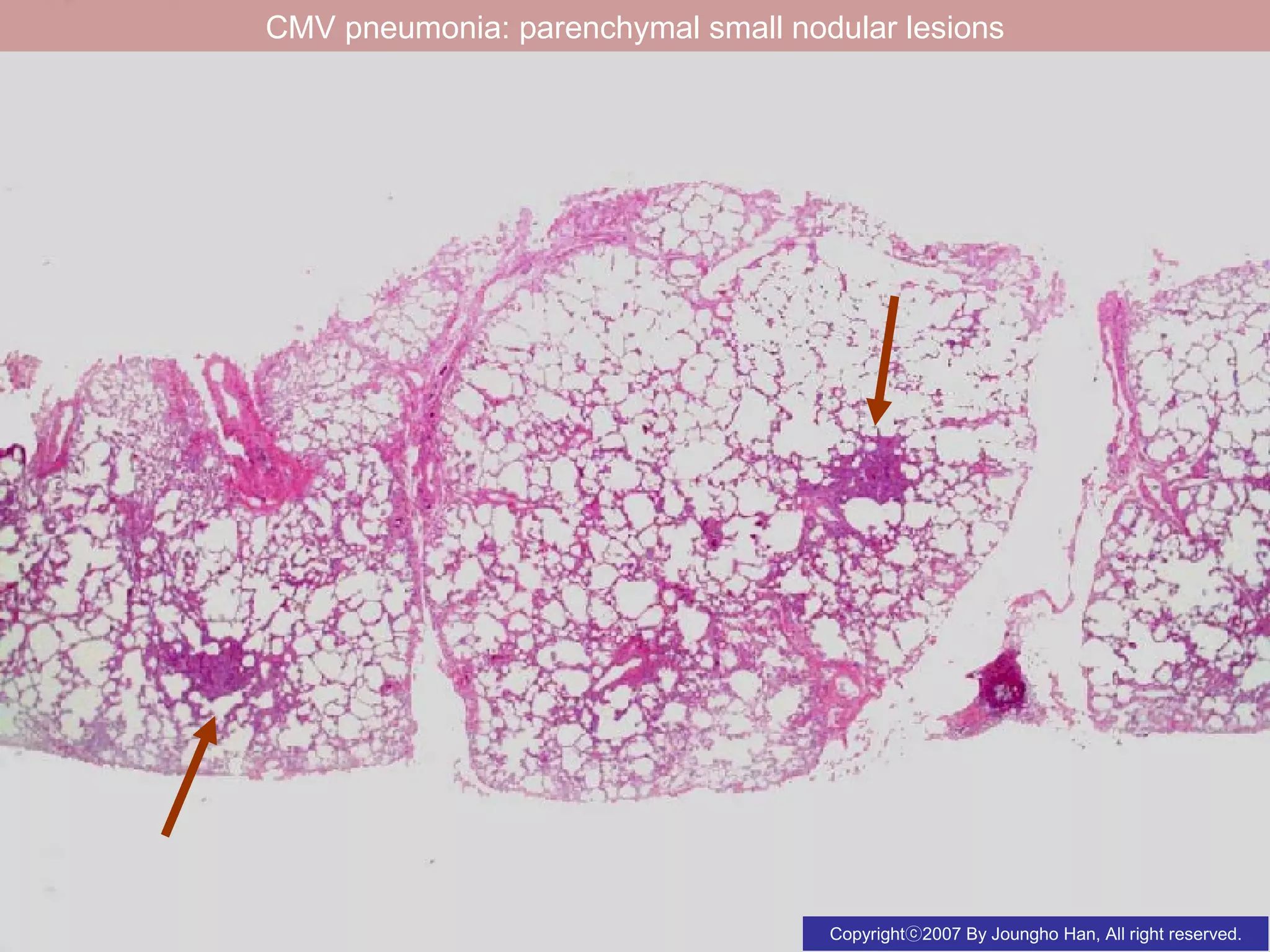 CMV pneumonia | PPS