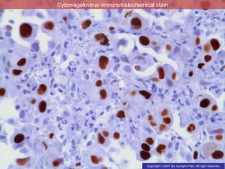 CMV pneumonia | PPS | Lung and Respiratory Health | Diseases and Conditions