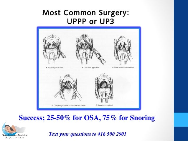 Sleep Apnea in CMV Operators