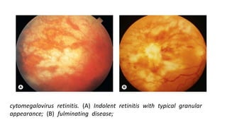 Cmv Retinitis