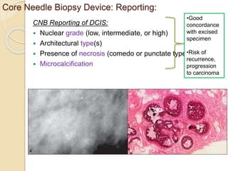cnbbreast-Core needle biopsy of breast : practical issues and updates | PDF
