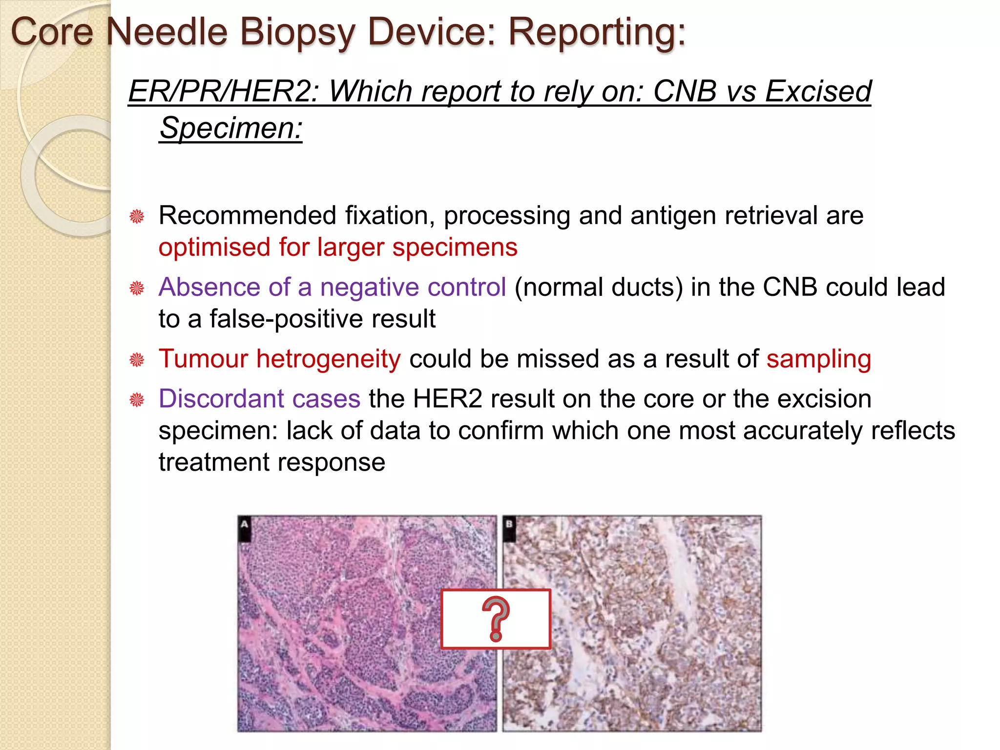 Core Needle Biopsy of Breast : Updates | PPTX