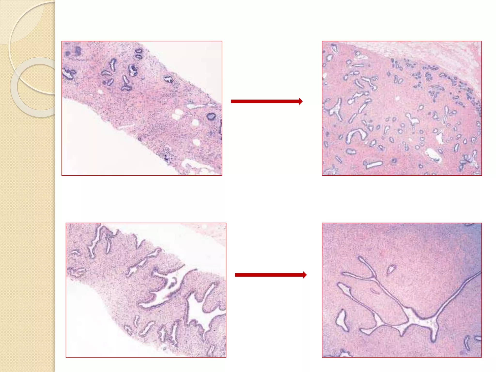 Core Needle Biopsy of Breast : Updates | PPTX