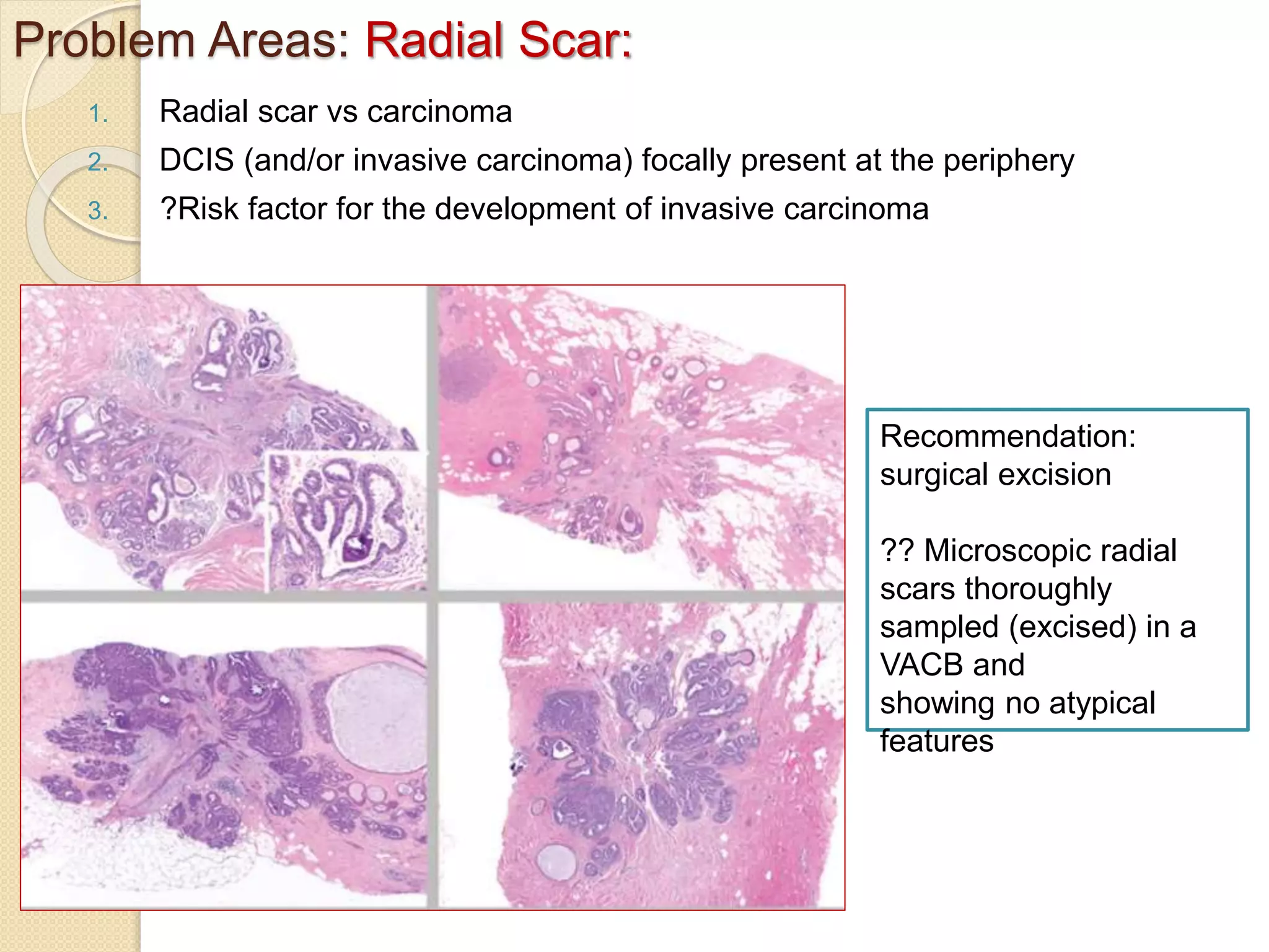 Core Needle Biopsy of Breast : Updates | PPTX