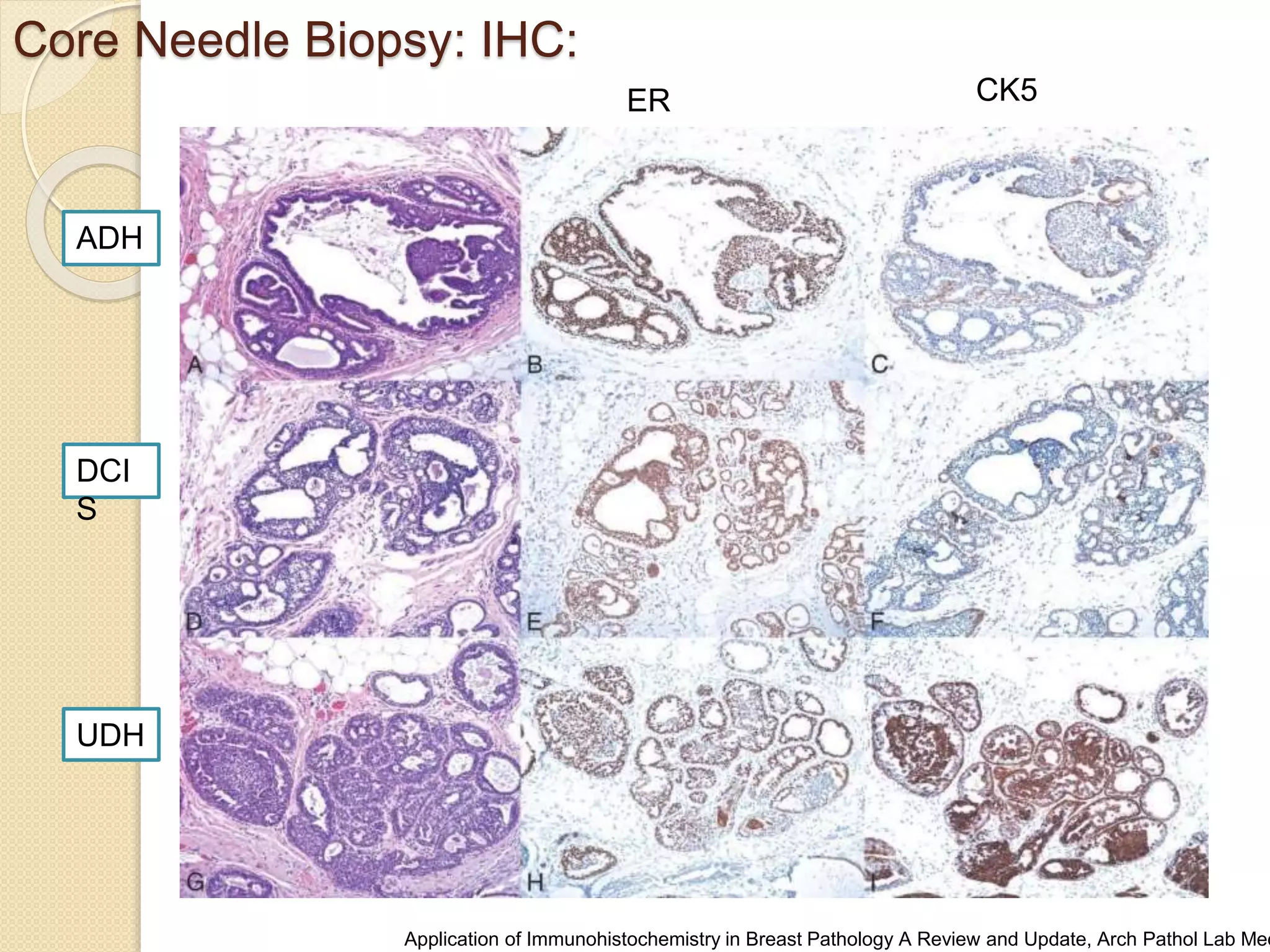 Core Needle Biopsy of Breast : Updates | PPTX