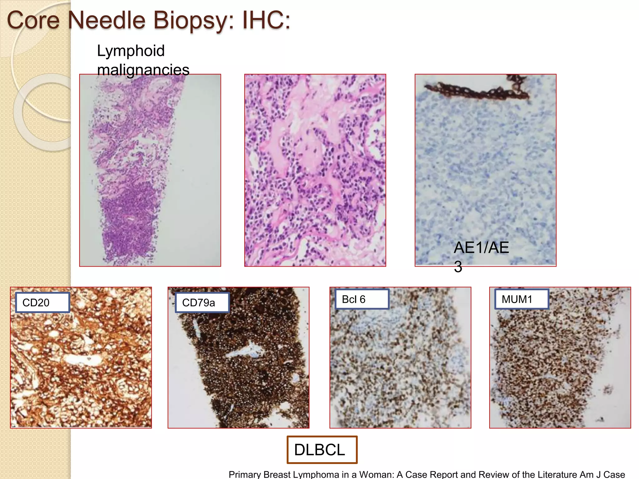 Core Needle Biopsy of Breast : Updates | PPTX | Cancer | Diseases and ...