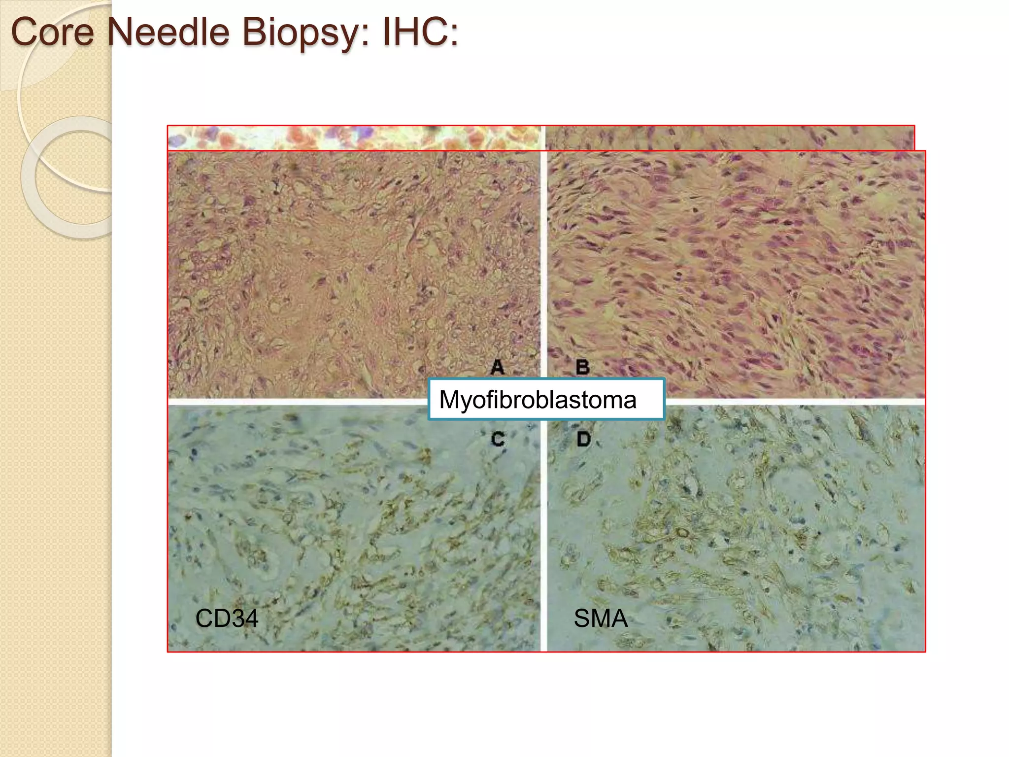 Core Needle Biopsy of Breast : Updates | PPTX