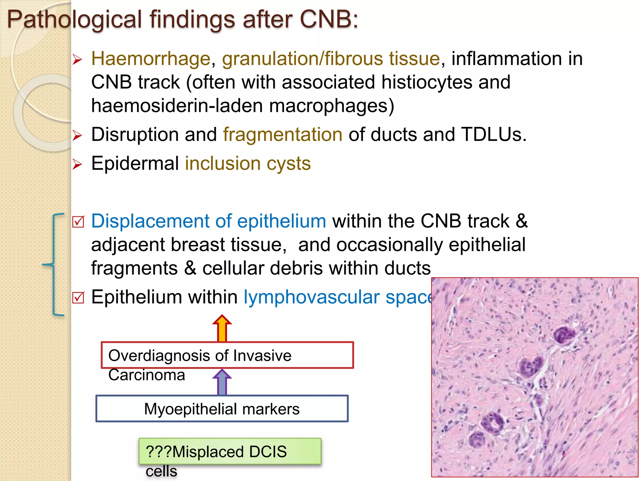 Core Needle Biopsy of Breast : Updates | PPTX