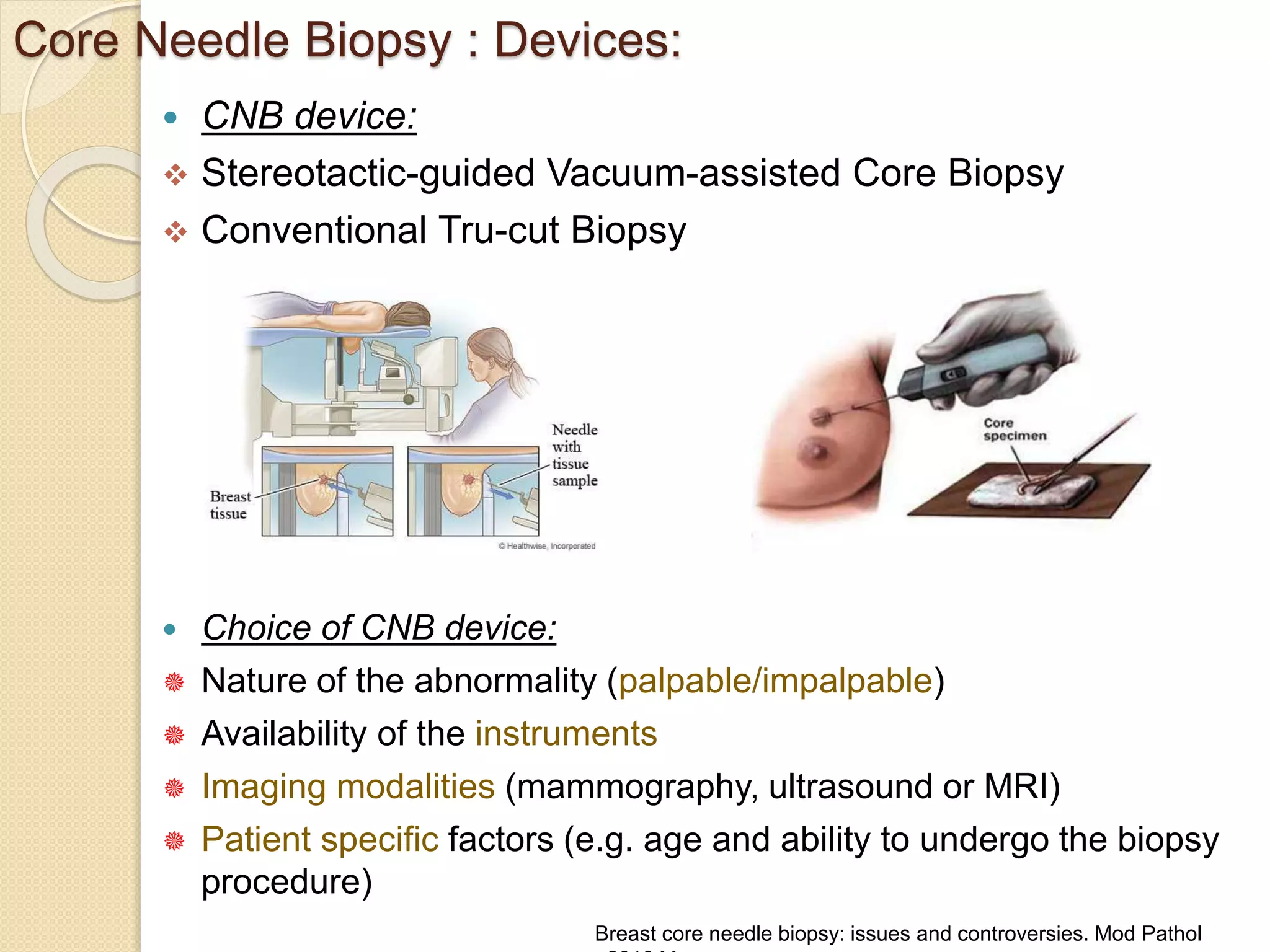 Core Needle Biopsy of Breast : Updates | PPTX | Cancer | Diseases and ...
