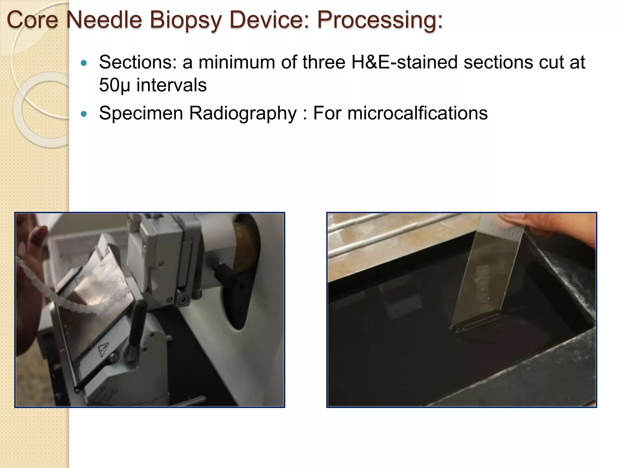 Core Needle Biopsy of Breast : Updates | PPTX