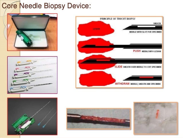 Core Needle Biopsy of Breast : Updates