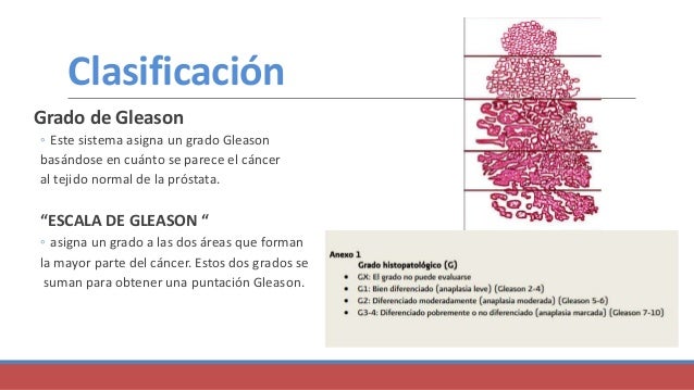 Cáncer de-próstata