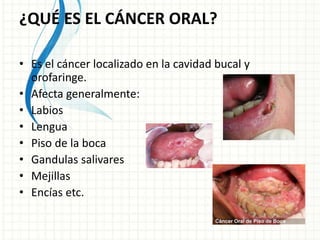 Cáncer oral | PPTX