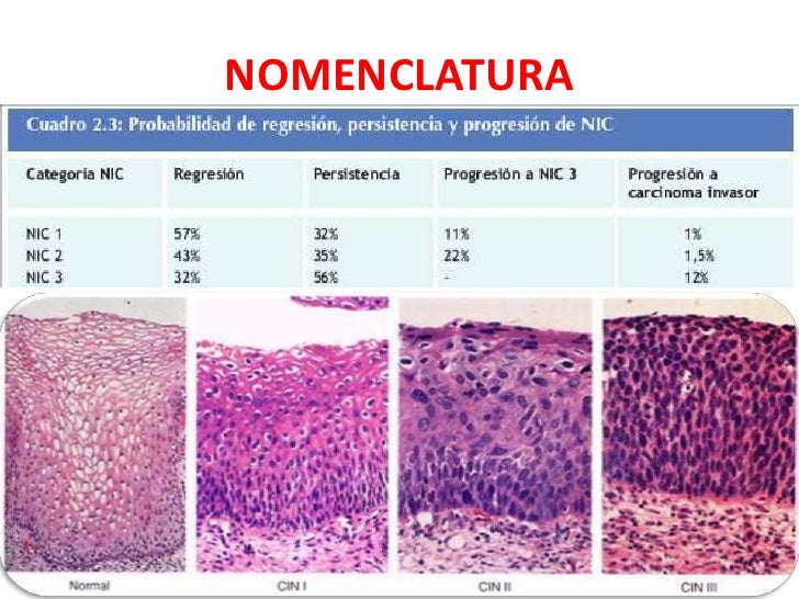 Cáncer cervicouterino