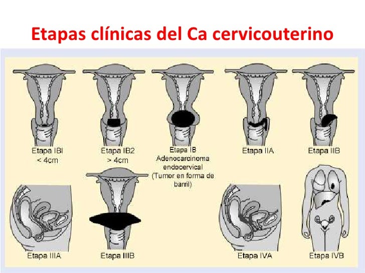 Cáncer cervicouterino