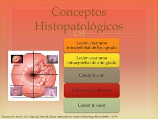 Cáncer cervicouterino | PPTX