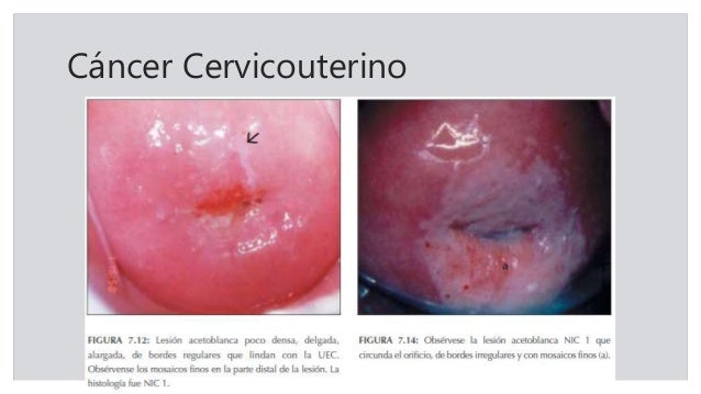 Cáncer Cervicouterino