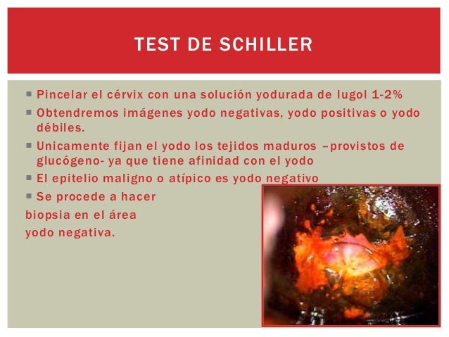 Cáncer cérvico uterino