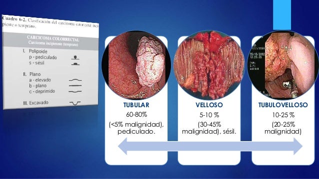 Cáncer de colon & recto