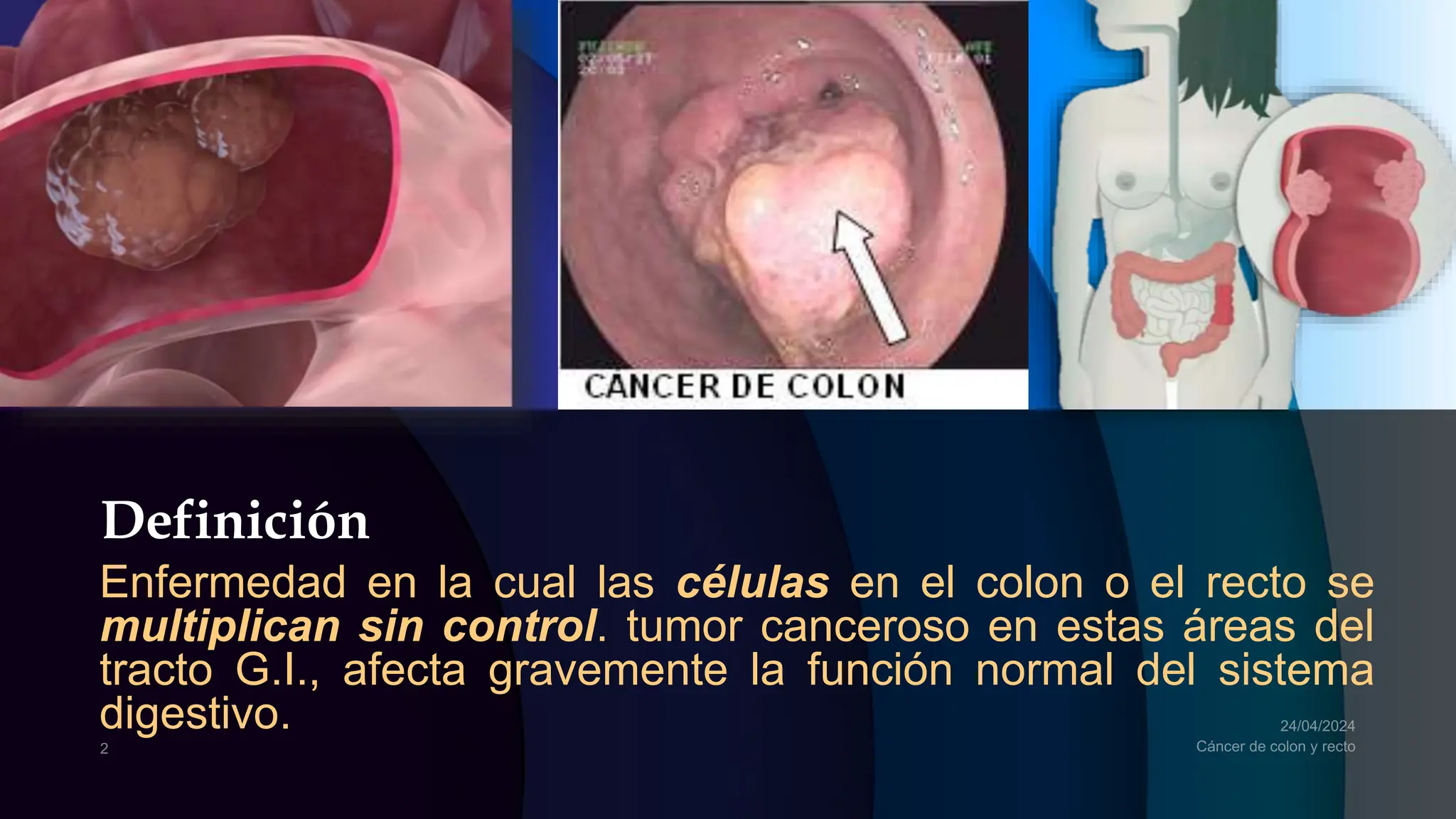 Cáncer de Colon y recto Gastroenterología.pptx