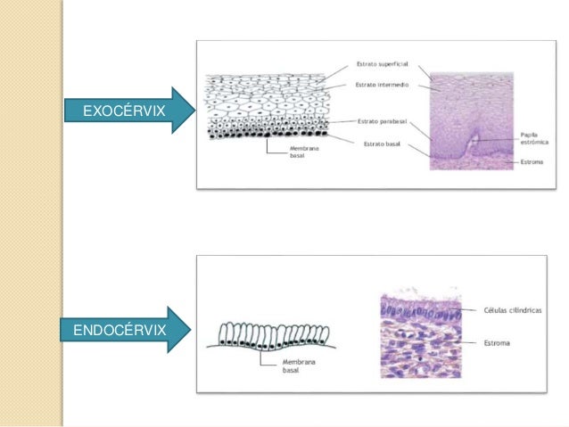 Cáncer de cuello de útero