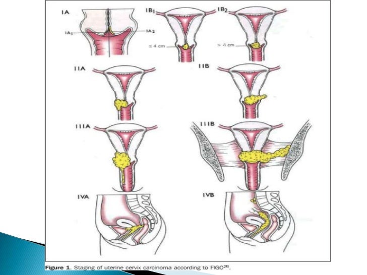 Clasificacion Tnm Cancer Endometrio