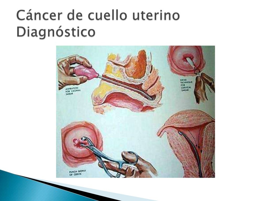 Cáncer de cuello uterino