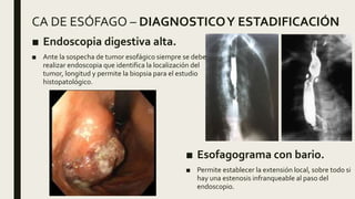 Cáncer de esófago | PPTX