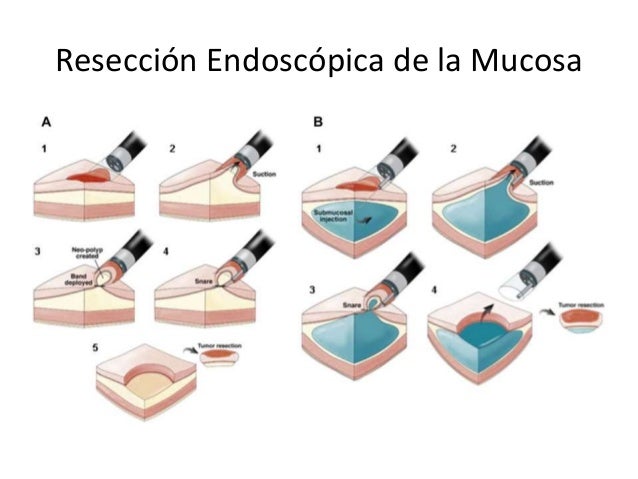 Detección y manejo endoscópico del cancer de esófago temprano
