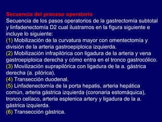 Cáncer de estómago | PPT