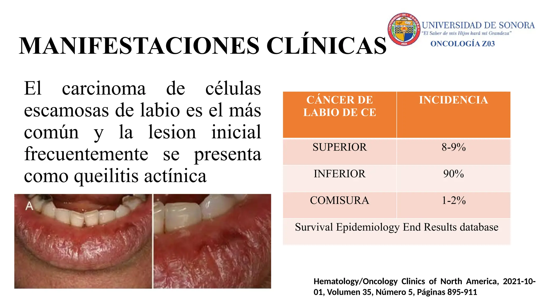 EPIDEMIOLOGÍA Y GENERALIDADES DE CÁNCER DE LABIO | PPTX