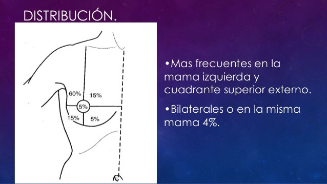 Cáncer de mama