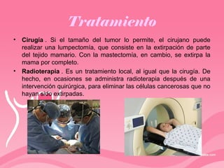 Cáncer de mama | PPT