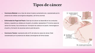 Cáncer de mama | PPTX