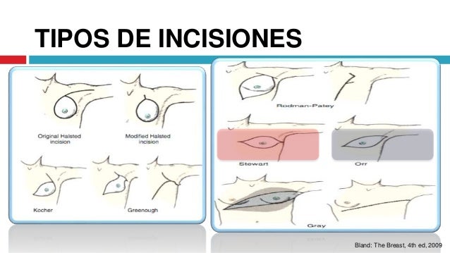 Cáncer de mama en etapa temprana
